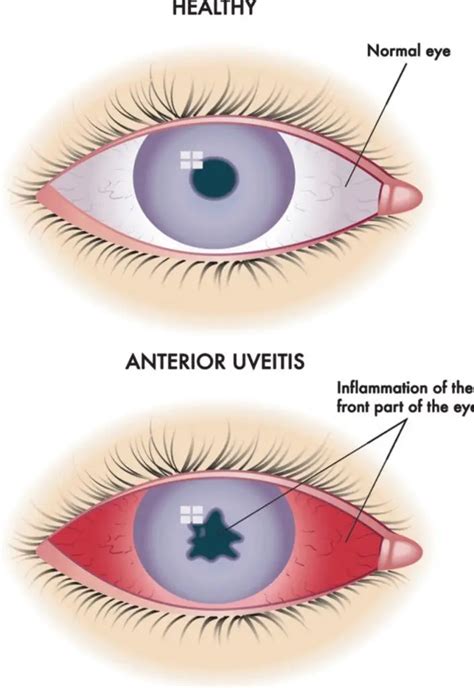 Uveitis Horizon Eye Physicians Baltimore Washington Eye Center