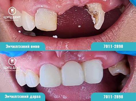 Шүдний ёзоор сэргээх Үүдэн Цэгц Дент шүдний эмнэлэг