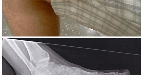 Didnt Watch His Step Rpics