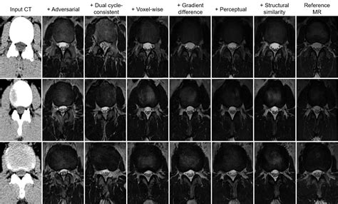GitHub ChengBinJin SpineC2M This Repository Includes Spine Data Based CT To MR Image Synthesis