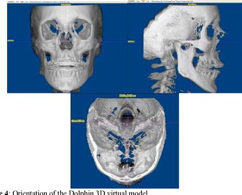 Figure 2 From Comparison Of Conventional And Cone Beam Ct Synthesized Cephalograms Semantic