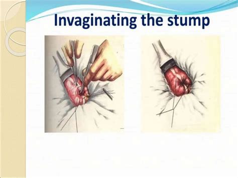 Appendicitis Clinical Sign Symptoms And Managementppt