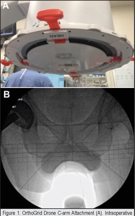 Figure 1 From Hip Offset And Leg Length Equalization In Direct Anterior Approach Total Hip