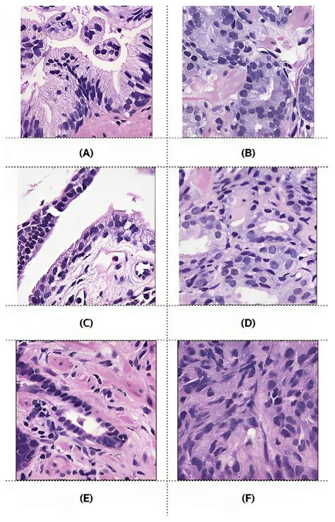 Binary Semantic Segmentation For Detection Of Prostate Adenocarcinoma