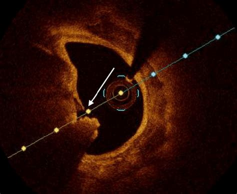 Oct Cross Sectional View Of Ruptured Atherosclerotic Plaque With Download Scientific Diagram