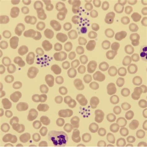 Typical Histogram And Result Print Out Sysmex Xe 5000 In Patient Ptcp Download Scientific