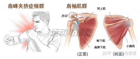 肩峰撞击综合征的4个康复阶段肩痛康复 知乎