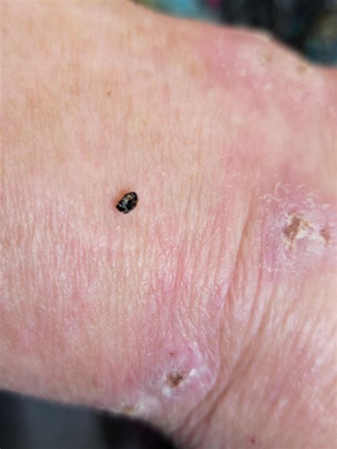 Carpenter Beetles Or Bed Bug R Bedbugs