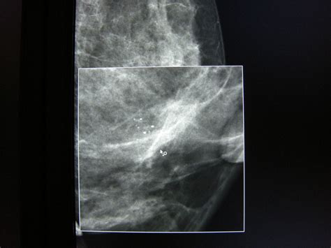 Impact Of Digital Mammography In The Detection And Management Of Microcalcifications