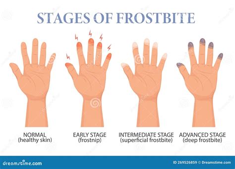 Frostbite Stages Frozen Hands In Different Stages Medical Frostbite