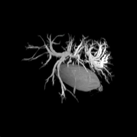 Abdelrhman Nasser On Linkedin Case Of Today Male Patient 63y With