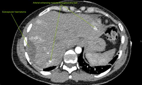 Ct Case 075 • Litfl • Ct Scan Interpretation