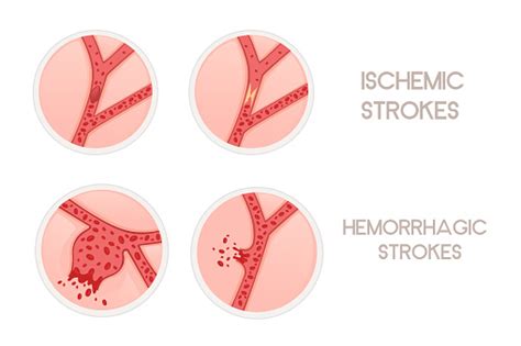 인체 해부학 질환 허혈성 뇌졸중 벡터 와 출혈성 뇌졸중 그림 통하고 있는 흰색 배경 건강관리와 의술에 대한 스톡 벡터 아트 및
