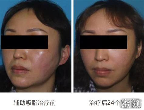 体雕仪器作用和原理分析 含天使光雕和黄金微雕 超脂塑区别 蜜颜优惠