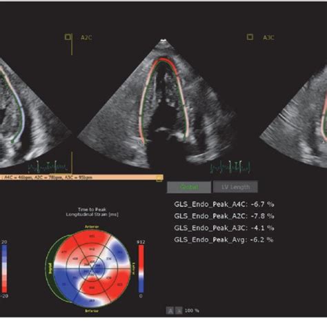 Transthoracic Echocardiography Demonstrating A Classic Cardiac Amyloid