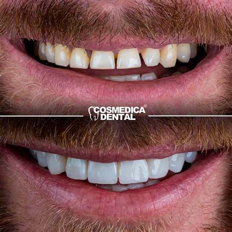 Turkey Teeth Before And After Cosmedica Dental Clinic