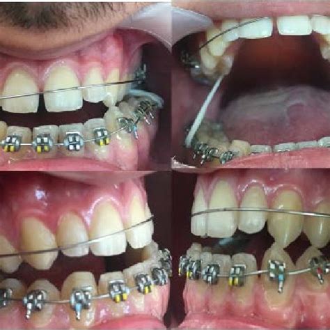 Box Elastics With Class Iii Vector On The Right Side And Class Ii