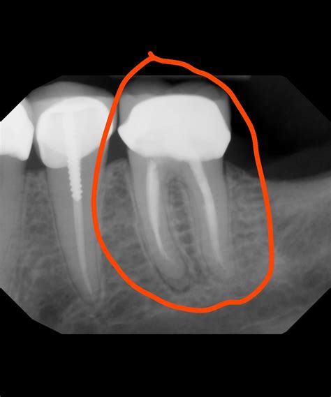 Periapical Abscess After Root Canal Gmlyp