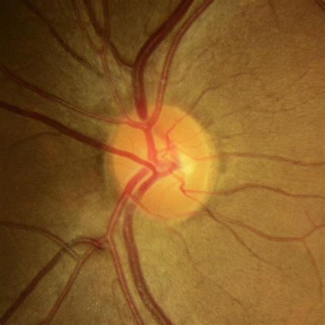 Glaucoma Dataset Eyepacs Airogs Light V2 Kaggle