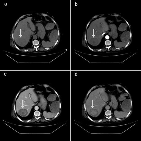 Axial Image Of Non Contrast Ct Of The Upper Abdomen A Shows A Download Scientific Diagram