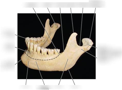 Condyloid Process And Mandibular Condyle