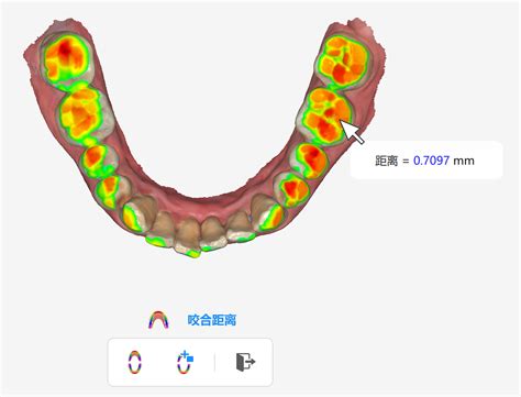 咬合距离 Runyes 口内扫描系统