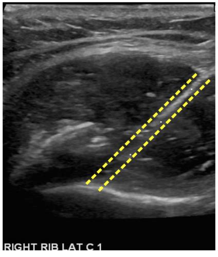 Chapter 18 Ultrasound Guided Interventional Techniques Flashcards Quizlet