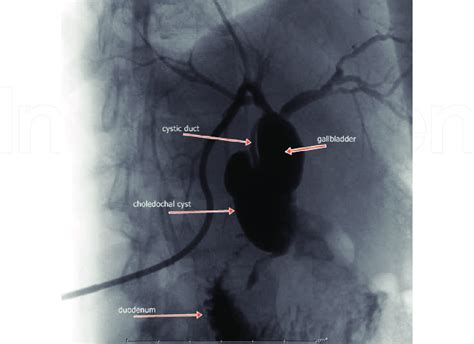 Ptc Reveals The Detailed Anatomy Of The Biliary Tracts And Associated