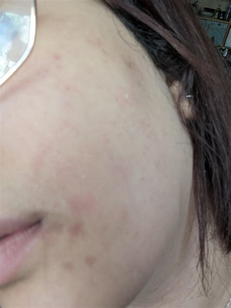 Face Psoriasis Rpsoriasis