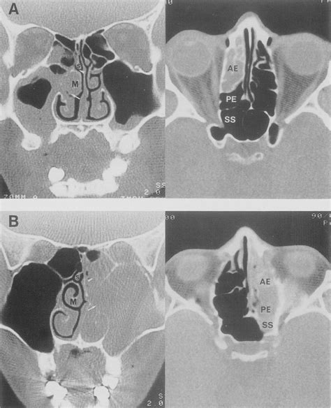A Right Maxillary Sinusitis B Left Maxillary Sinusitis In Case A