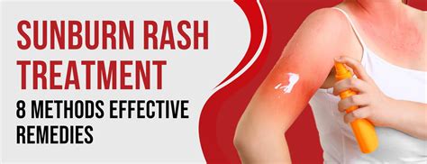 Sunburn Rash Treatment 8 Methods Effective Remedies