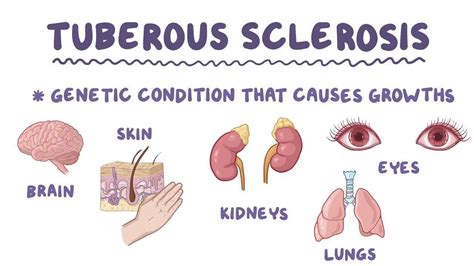 Tuberous Sclerosis Video Causes And Meaning Osmosis
