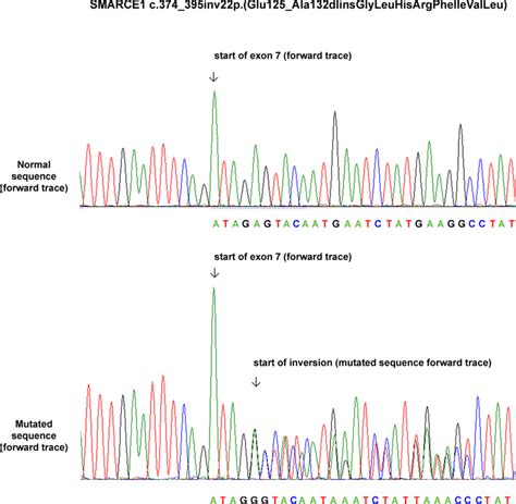 Gene Sequencing Chromatogram Outlining The Patient S Germline SMARCE Download Scientific