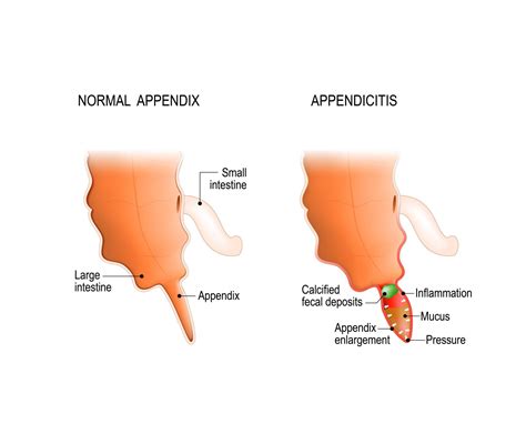 Types Of Appendicitis Gbl Hospital