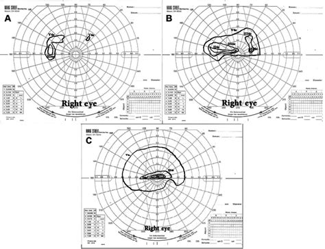 Goldmann Visual Field Of The Right Eye Notes A At 3 Weeks After Download Scientific