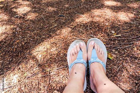 Will Sand Fly Bites Leave Scars At Werner Taylor Blog