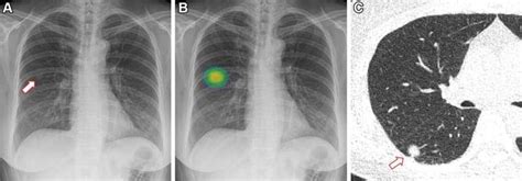 Ai Improves Lung Nodule Detection On Chest X Rays