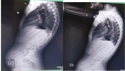 Spondyloepiphyseal Dysplasia Congenita Prognosis