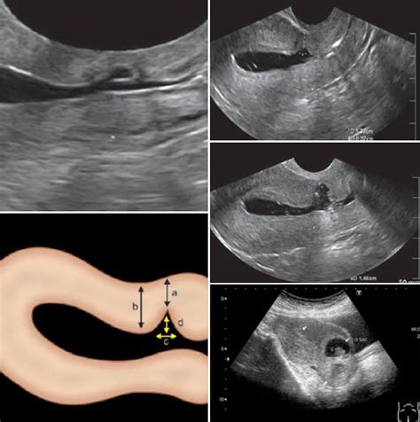 Cesarean Scar Niche Defect Important To Check The Residual Myometrial Tissue At The Site Of