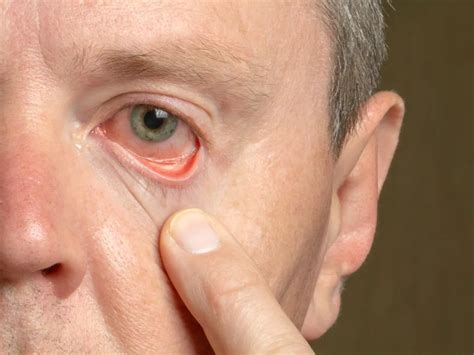 Hiv Dark Ring Around Eye