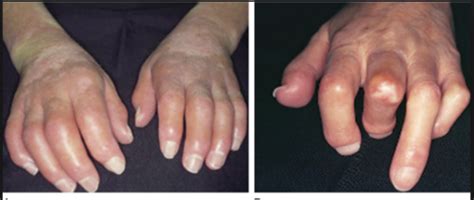 Medicine Hepatology Primary Biliary Cholangitis PBC Flashcards Quizlet