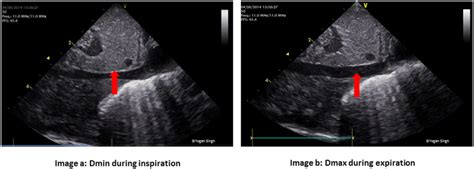 Physiological Variation In Inferior Vena Cava Ivc Diameter Normal Download Scientific