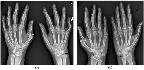 Hand And Wrist Involvement In Seropositive Rheumatoid Arthritis