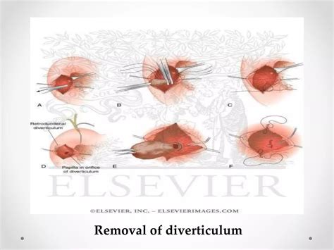 Duodenum And Duodenal Diverticulum Pptx