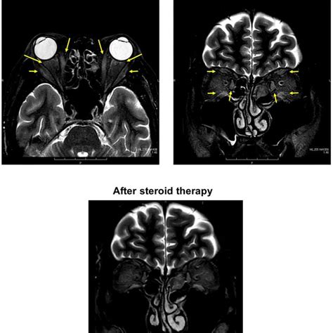 Upper In Orbital Magnetic Resonance Imaging Before Starting