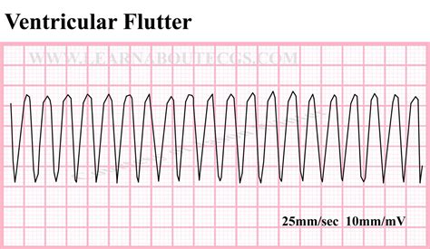 Ventricular Flutter By Electrocardiology On Etsy
