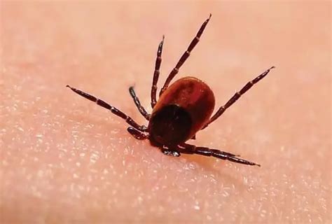 Typhus Diagnostic Methods Causative Agent Symptoms Therapy And