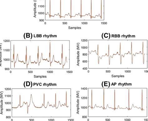 심실조기수축 Pvc 원인 증상에 대해 네이버 블로그