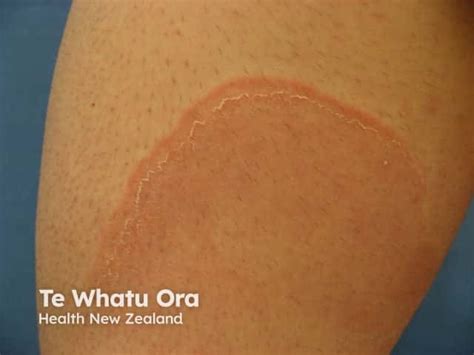 Erythema Annulare Centrifugum Image