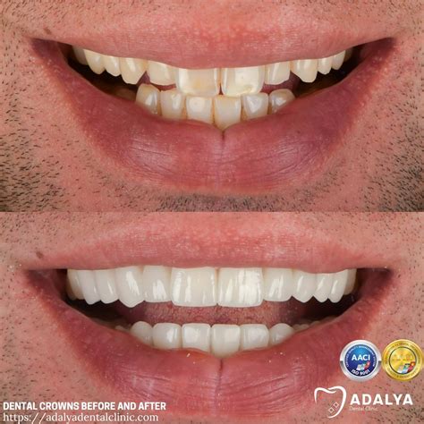 Dental Crowns Before And After Adalya Dental Clinic